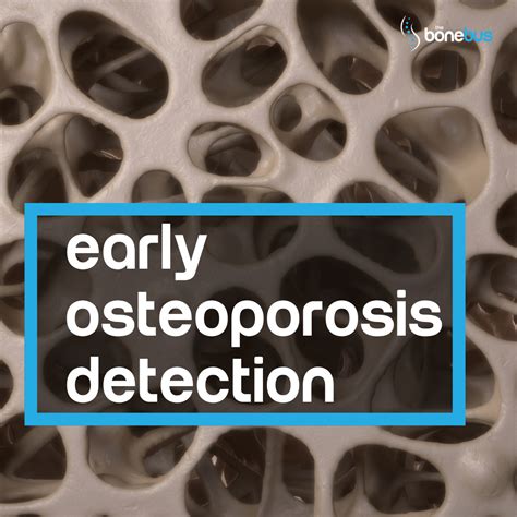 The Dexa Scan Your Key To Early Osteoporosis Detection The Bone Bus