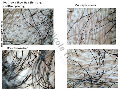 We Offer Microscopic Digital Analysis Of The Scalp To Help Us Determine The Extent Of The Damage We Offer Microscopic Digital Analysis Of The Scalp To Help Us Determine The Extent Of The Damage