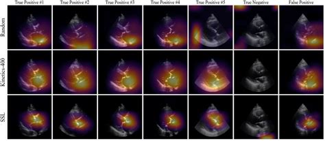 Automated Detection Of Severe Aortic Stenosis Using 40 Off