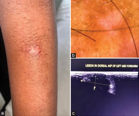 An Asymptomatic Nodular Lesion Over The Forearm A Diagnostic Dilemma