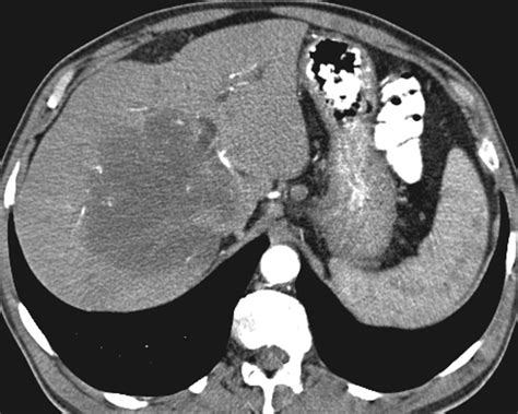 Liver Atlas Diagnosis Cholangiocarcinoma