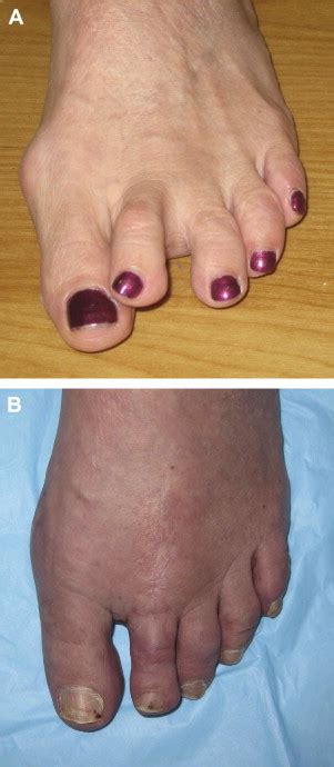 The Crossover Toe And Valgus Toe Deformity Foot And Ankle Clinics