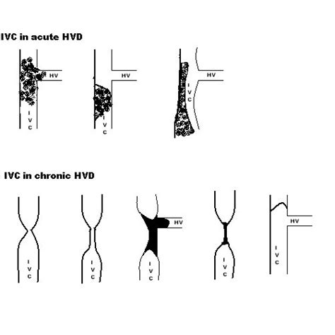 Presence Of Dilated Superficial Veins In Abdomen And Ascites In Hvd