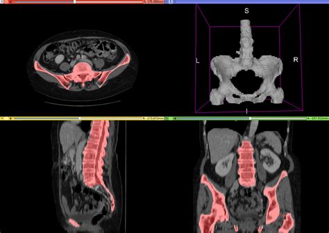 Example Of CT Skeleton Detection And Segmentation By Image Morphology Download Scientific