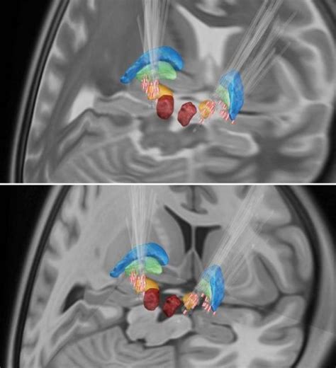 Subthalamic Nucleus Neurosurgery Blog
