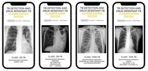 Drug Resistant Tuberculosis Treatment Recommendation And Multi Class Tuberculosis Detection And