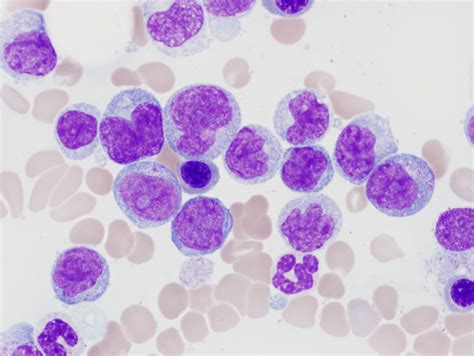 Reactive Lymphocytes Vs Monocytes