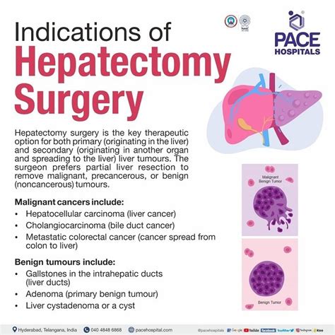 Hepatectomy Surgery In Hyderabad Types Procedure Indications And Cost