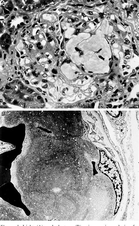 Figure 1 From Apolipoprotein E2 E5 Variants In Lipoprotein Glomerulopathy Recurred In
