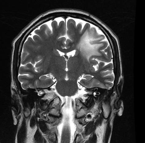 An Interesting Case Of Tumefactive Demyelination Eurorad