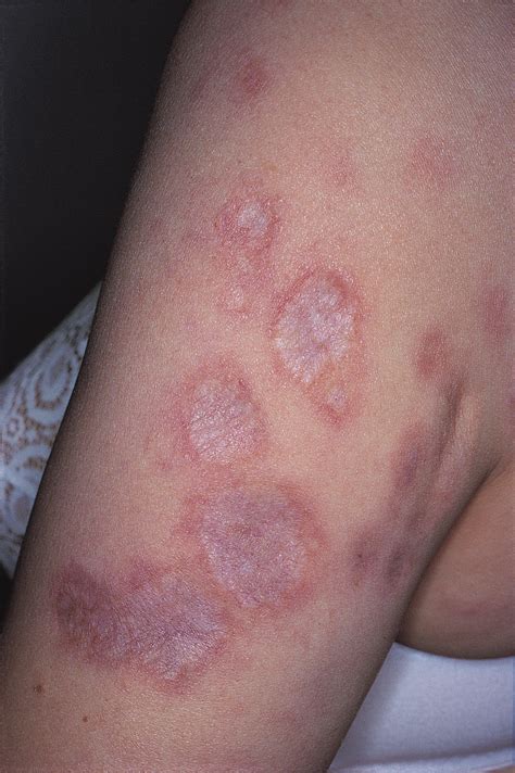 Sarcoidosi Cutanea Cause Sintomi E Cura Porn Sex Picture