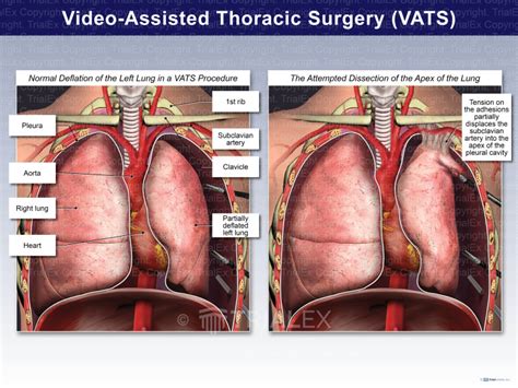 Video Assisted Thoracic Surgery Vats Trialexhibits Inc