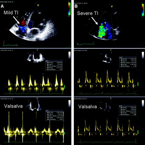 Examples Of Valsalva Maneuver