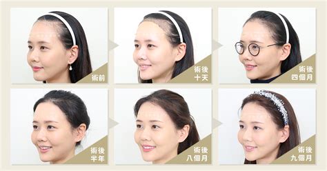 高額頭女生髮際線植髮心得醫師親自體驗植髮推薦案例分享 毛髮衛教 澤林毛髮診所