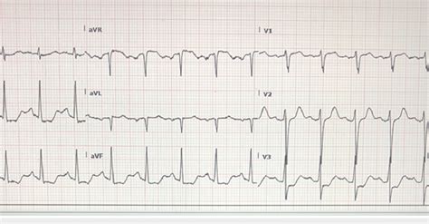 Initial Ekg Performed Showing Sinus Tachycardia At 130 Bpm With Download Scientific Diagram