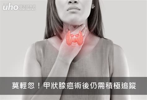 莫輕忽！甲狀腺癌術後仍需積極追蹤 Uho優活健康網