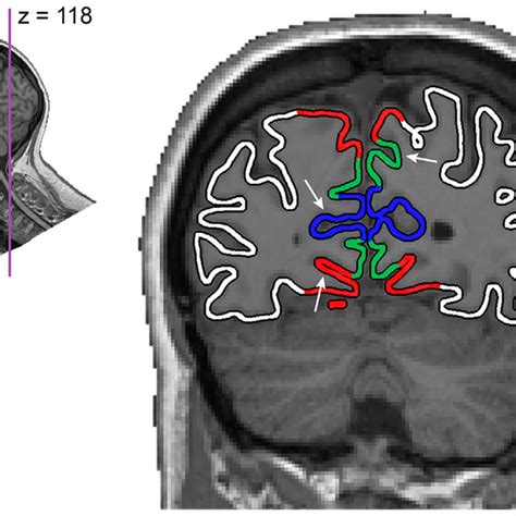 An Example Folding Pattern In Occipital Cortex Download Scientific Diagram