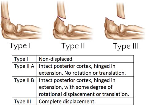 Assessing The Reliability Of The Modified Gartland Classification