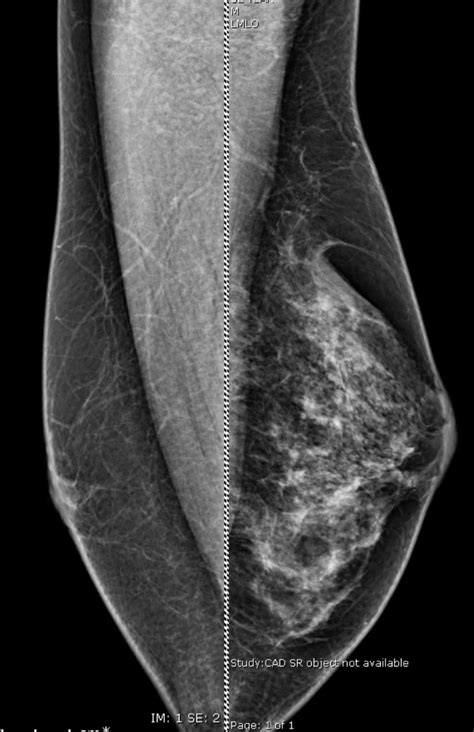 Mlo Views Left Breast In A Male With Diffuse Gynecomastia Right