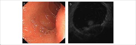 Duodenal Heterotopic Pancreas Misdiagnosed As Gist By Eus Eus Download Scientific Diagram
