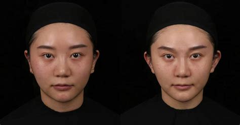 New Research Lateralizing Auricles Cotofana Anatomy