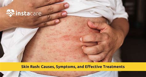 Skin Rash Causes Symptoms Types And Effective Treatments