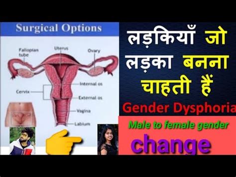 Gender change surgery सकस चज सरजर male to female sex reassignment male to female
