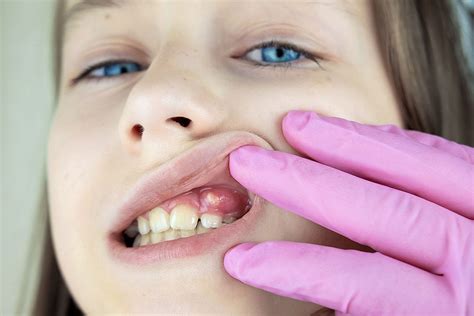The Role Of Bacterial Infection In Abscessed Teeth After Root Canal Treatment By
