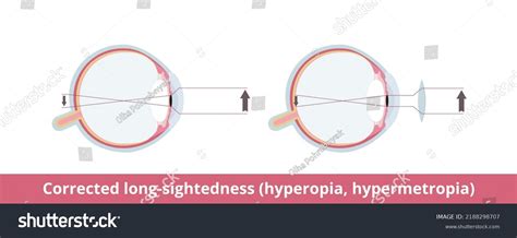 Corrected Longsightedness Hyperopia Hypermetropia Eye Condition Stock Vector Royalty Free