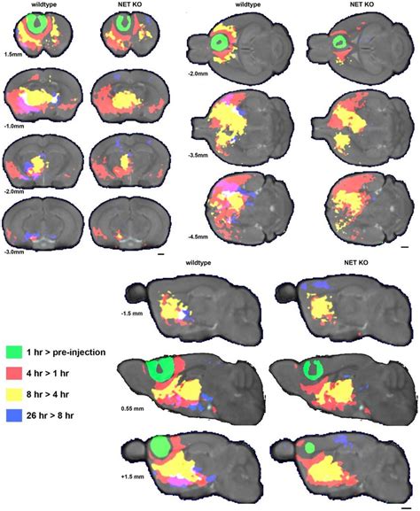 Statistical Parametric Maps Show The Progression Of Mn 2 Accumulation Download Scientific