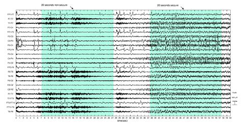 Figure 1 From Eeg Based Seizure Detection Using Discrete Wavelet Transform Through Full Level