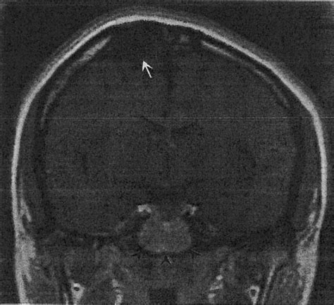Parietal Bone Defect Differential Diagnosis And Neurologic Associations Pediatric Neurology