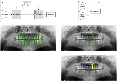 A Sequential Framework For Detection And Classification Of Abnormal Teeth In Panoramic X Rays