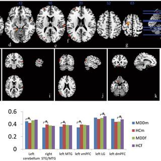 Sex By Diagnosis Interaction In GMV Maps Significant Sex By Diagnosis Download Scientific