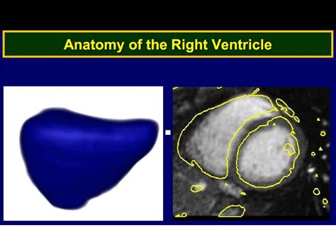 75574537 Assessment Of Right Ventricular Functionppt