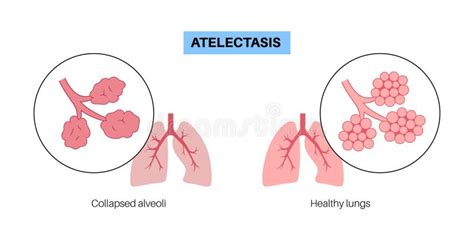 Atelectasis Medical Poster Stock Vector Illustration Of Diagram