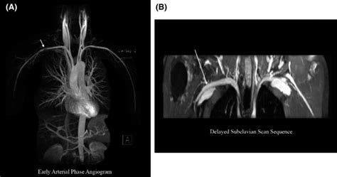 early arterial phase angiography versus venous phase imaging a