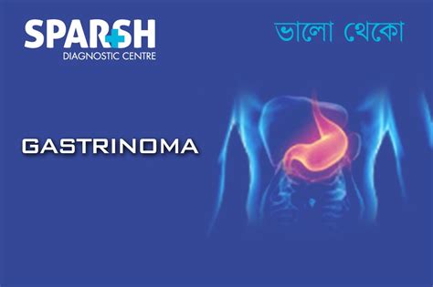 Gastrinoma Sparsh Diagnostic Center