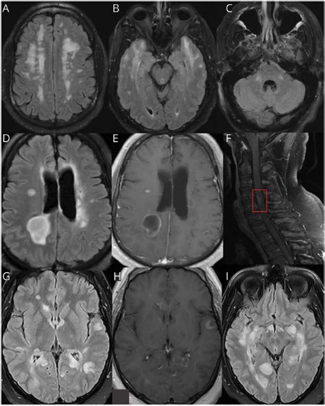 Neuroimaging Examples From The Mgb Case Series Download Scientific