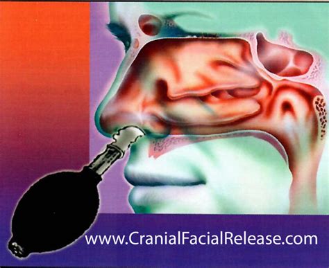 Faqs Cranial Facial Release