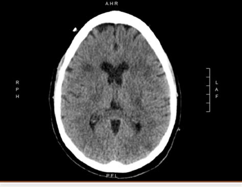 Ct Scan Showing Confluent Multifocal White Matter And Basal Ganglia Download Scientific Diagram
