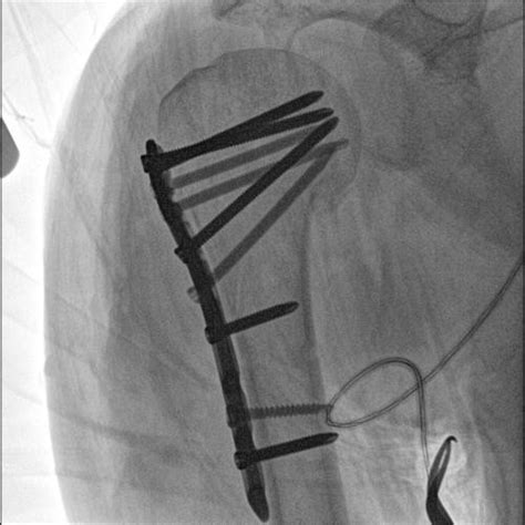 Mobile C Arm X Ray Machine With 360° Rotation Arm Suppliers Factory Pricelist Wemed