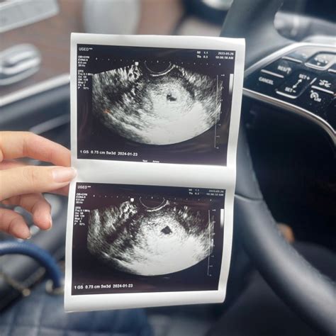 임신5주차 증상 임밍아웃 피검사 더블링 아기집 울퉁불퉁 네이버 블로그