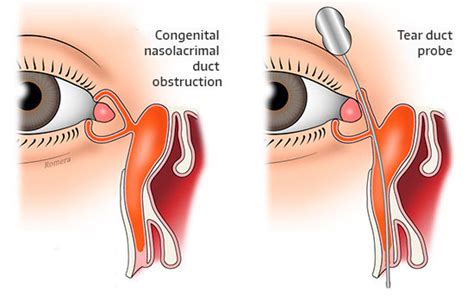 Nasolacrimal Duct Obstruction Congenital Fyri