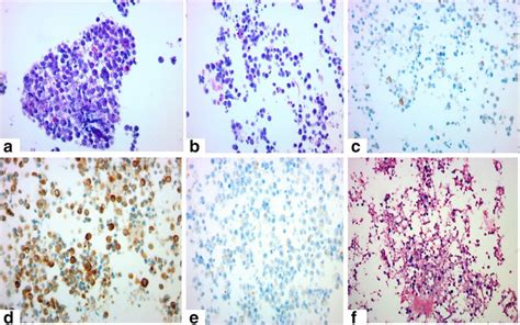 Cytology From The Fine Needle Aspirate Specimen Shows Discohesive Cells