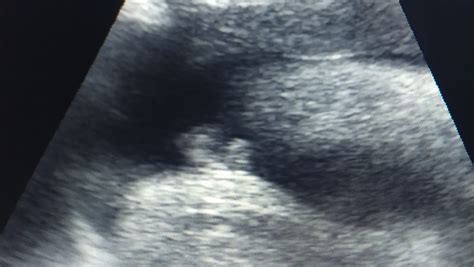 Cystocele Ultrasound