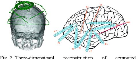Figure 2 From Automatic Detection Of High Frequency Oscillations In Invasive Recordings