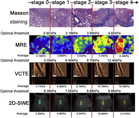Direct Comparison Of Us And Mr Elastography For Staging Liver Fibrosis