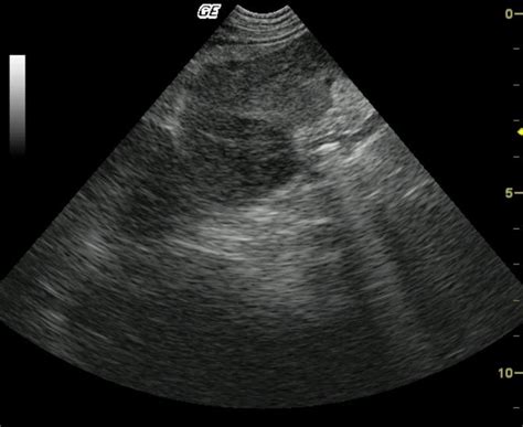 Fibrosarcoma Of The Spleen And Liver Diagnosed By Tru Cut Biopsy In A 10 Year Old Mn Pug Members