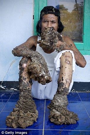 Tree Man of Indonesia Afflicted by Branch Like Warts dіeѕ Without Fulfilling Dream of a Cure